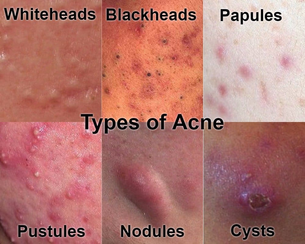 severe cystic acne