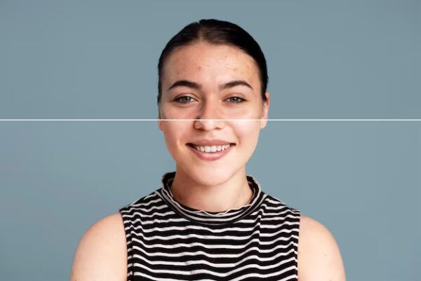 Acne Face Map: What Breakouts on Each Area of Your Face Mean | Sozo Clinic